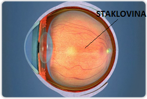 Staklovina (staklasto tijelo) | Alensa.hr